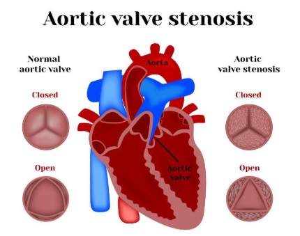 Keyhole Aortic Valve Surgery - Mr. Kulvinder Lal